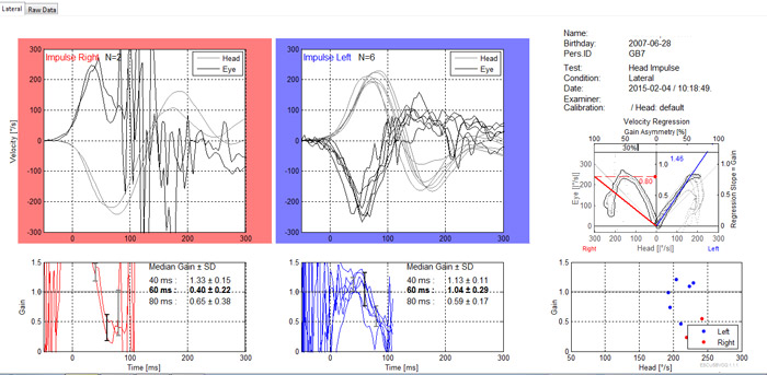 VIDEO: Video Head Impulse Test (vHIT) with Children